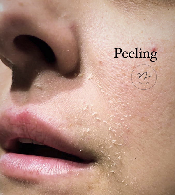 Cuidados posteriores al peeling facial - NatiroBeauty